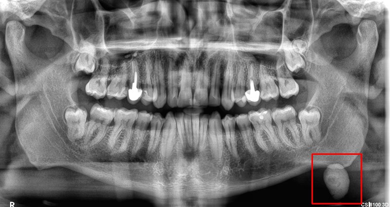 Caso N° 81: Ganglio Linfático Calcificado | Radiodontica.ar